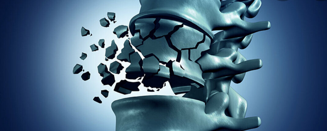 Uføretrygdet alenemor med 3 brudd i ryggen | Spleis fra SpareBank 1